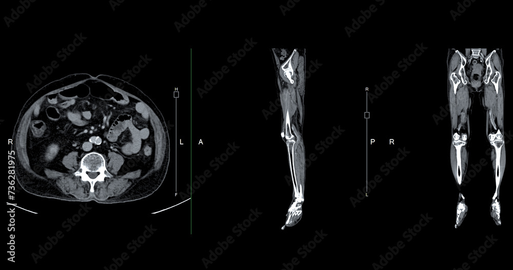A CT venogram of the leg is a non-invasive imaging procedure offering ...