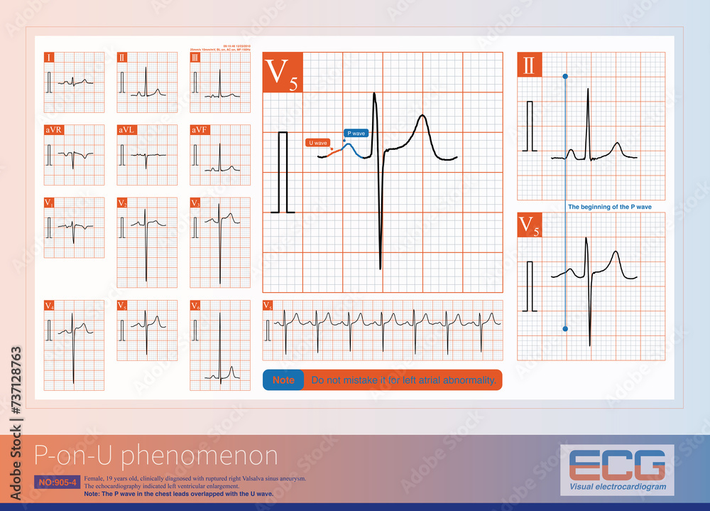 Sometimes, when the P wave overlaps with the previous U-wave, do not ...