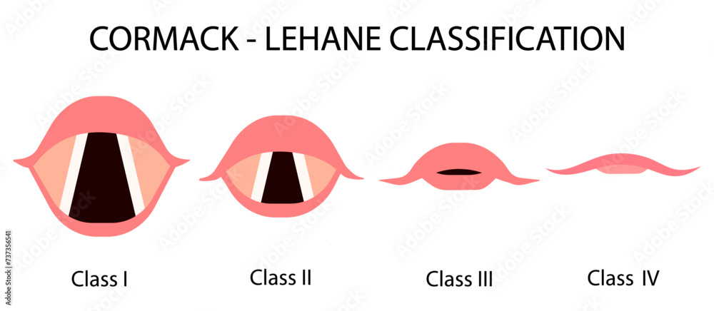 The Cormack–Lehane (CL) classification system classifies views obtained ...