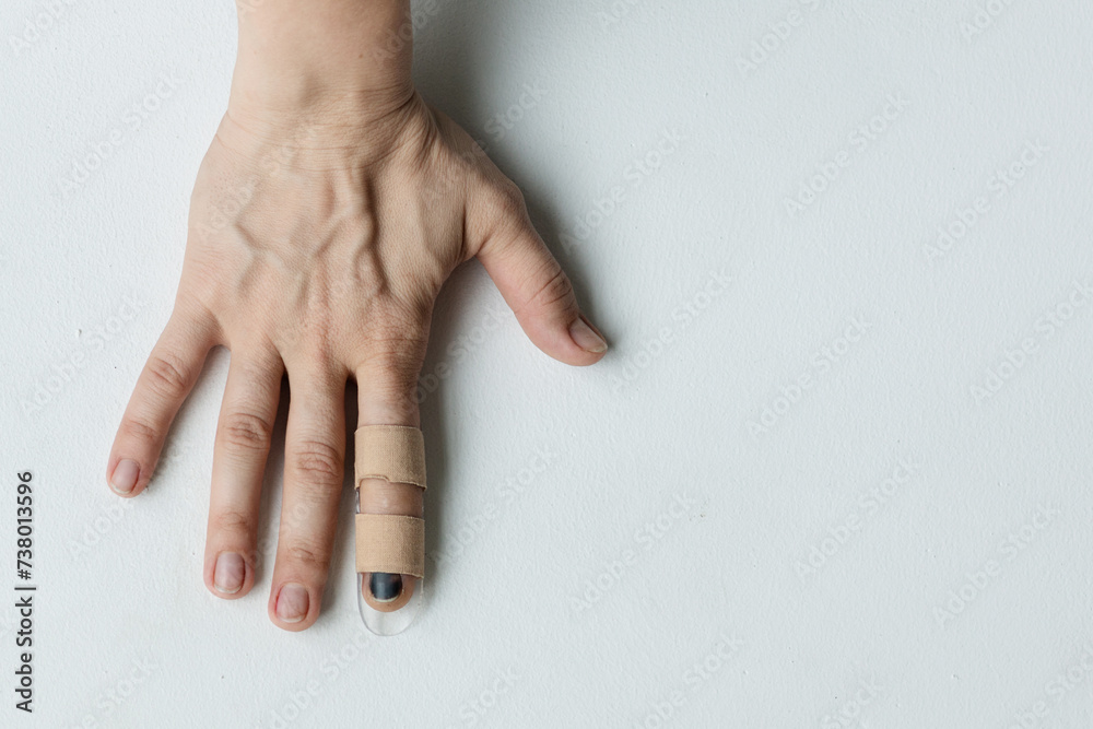 Hematoma on the index finger of a woman's hand, formed as a result of a ...