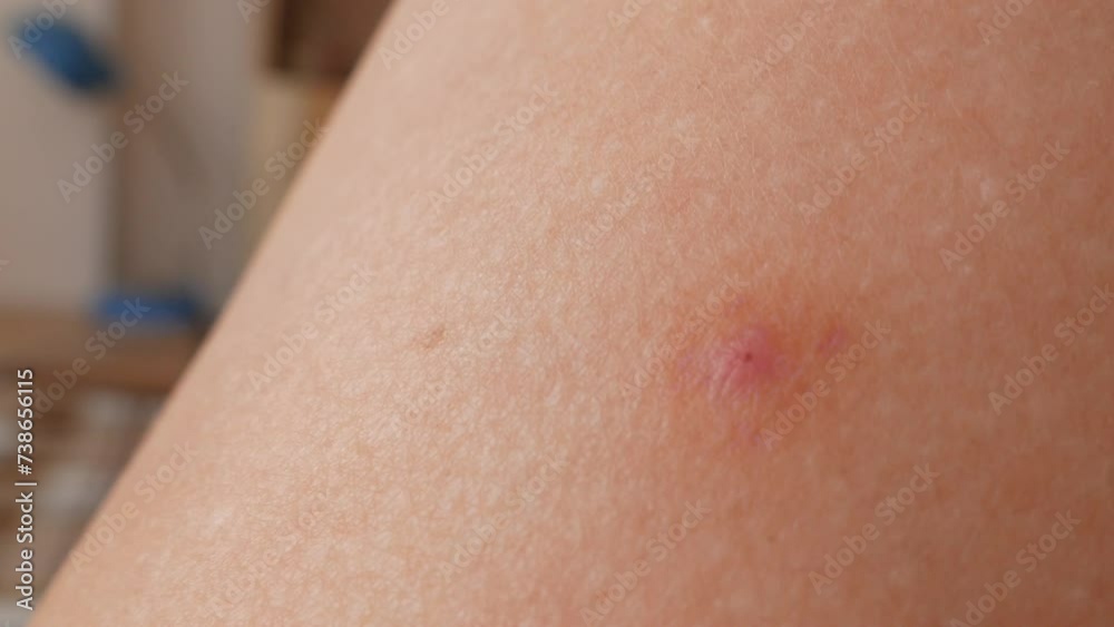 mosquito bites ticks on woman's legs, big red spots on skin, Lyme ...