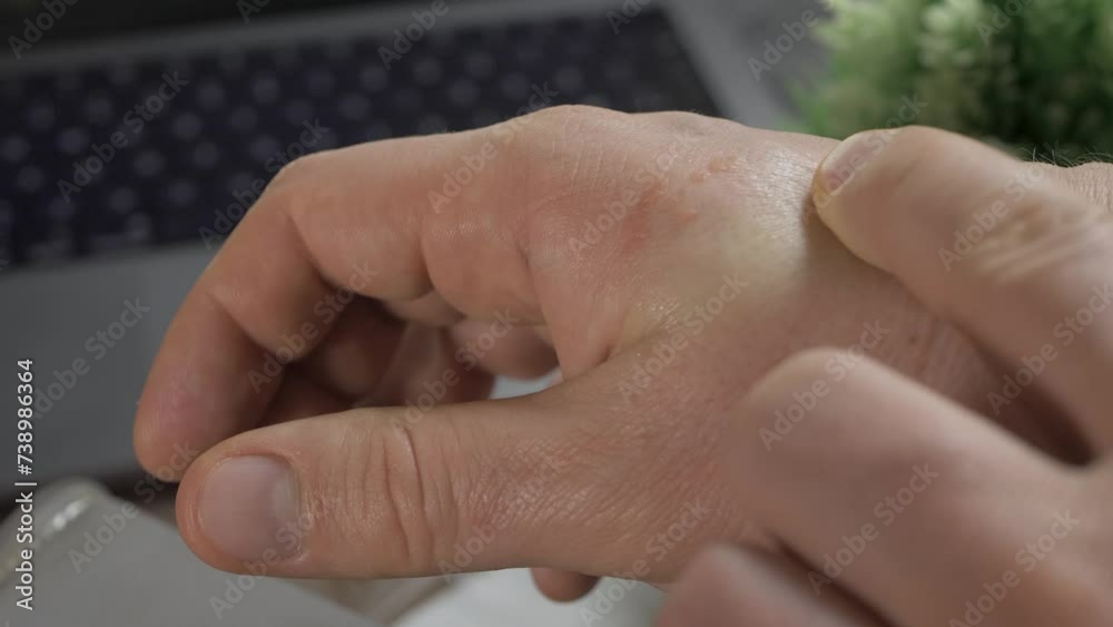 Viruses like HPV can cause papillomas and skin growths on your hands ...