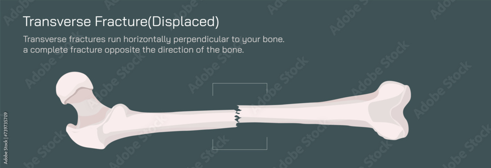 Types of bone fracture. Structure of a bone vector illustration. The ...