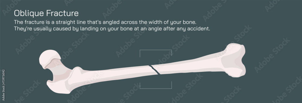 Types of bone fracture. Structure of a bone vector illustration. The ...