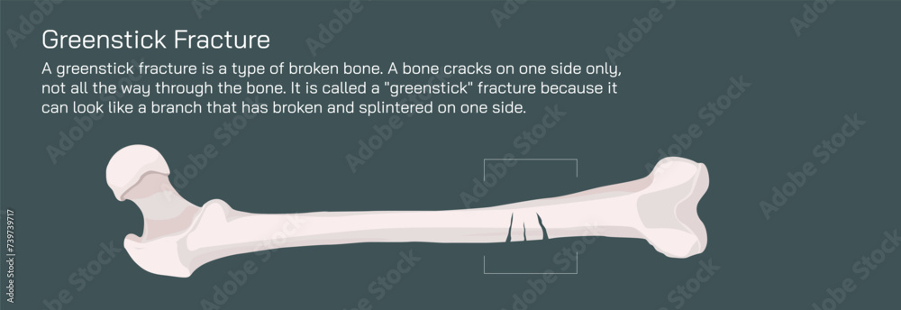 Types of bone fracture. Structure of a bone vector illustration. The ...