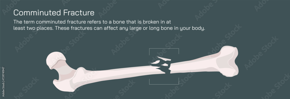 Types of bone fracture. Structure of a bone vector illustration. The ...