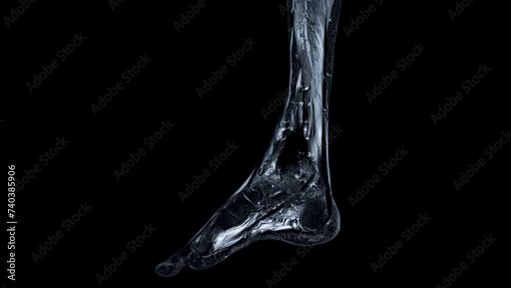 MRI FOOT scan Sagittal view T2 Fat suppression technique for diagnostic ...