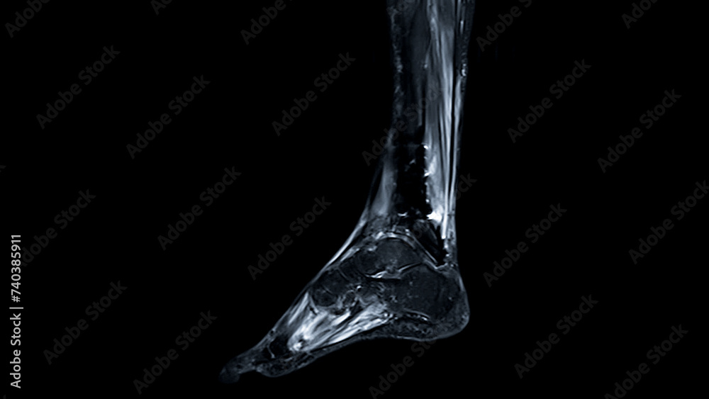 MRI FOOT scan Sagittal view T2 Fat suppression technique for diagnostic ...