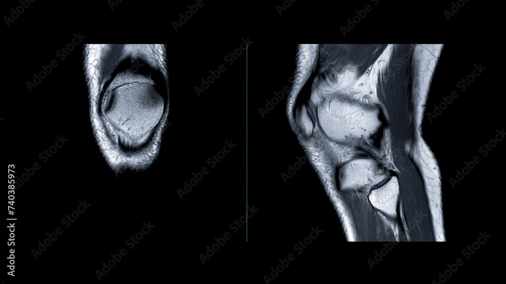 Magnetic resonance imaging or MRI of knee joint. This diagnostic ...
