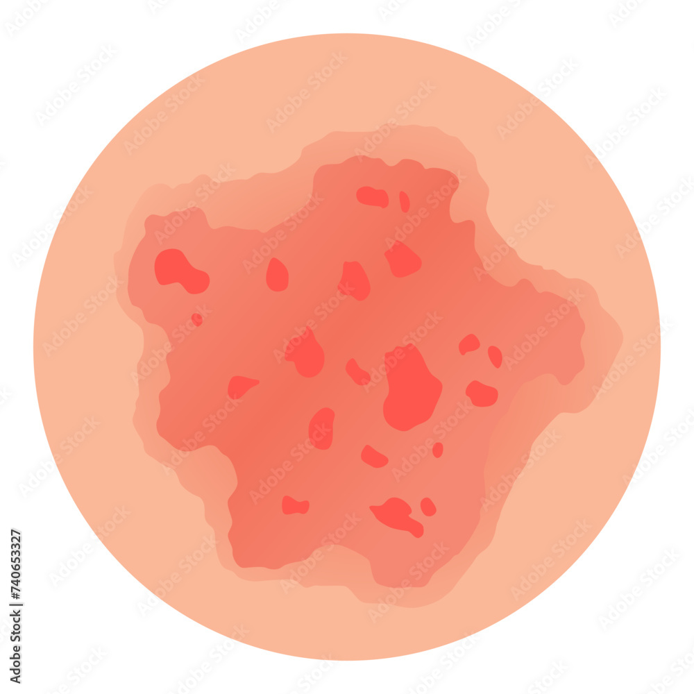 Type of psoriasis vector. Part of patients skin with dermatitis ...