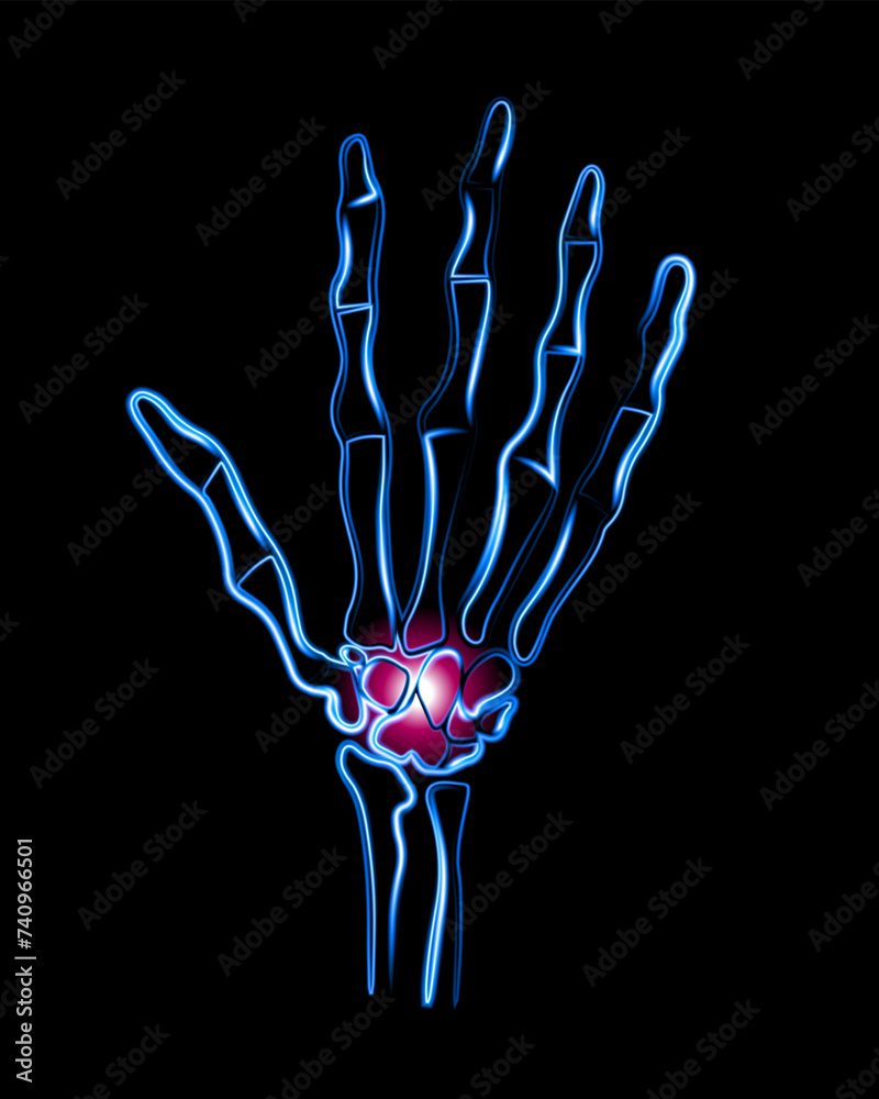 Vector isolated illustration of wrist pain. Hand with localization of ...