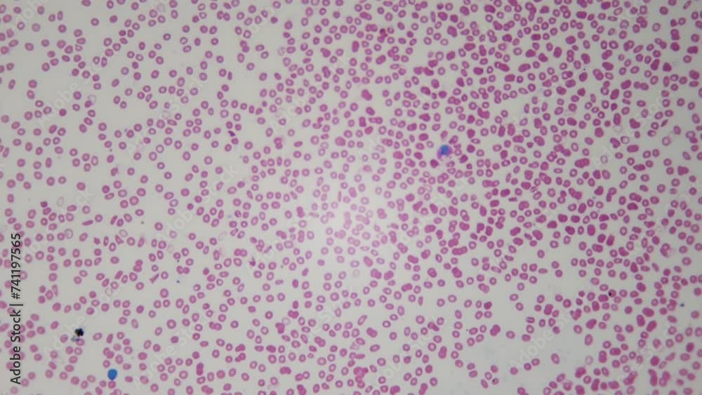 Blood analysis under microscope. Main method of determining general ...