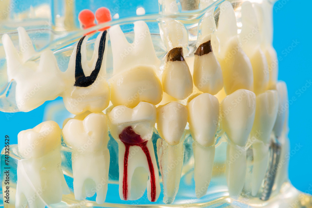 Mockup of a dental jaw with diseased teeth. Inflamed tooth canal ...