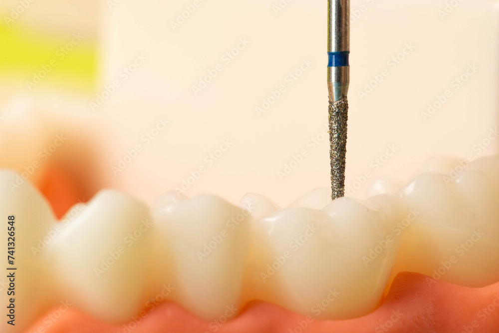 The diamond drill of the drill polishes the new filling installed on ...