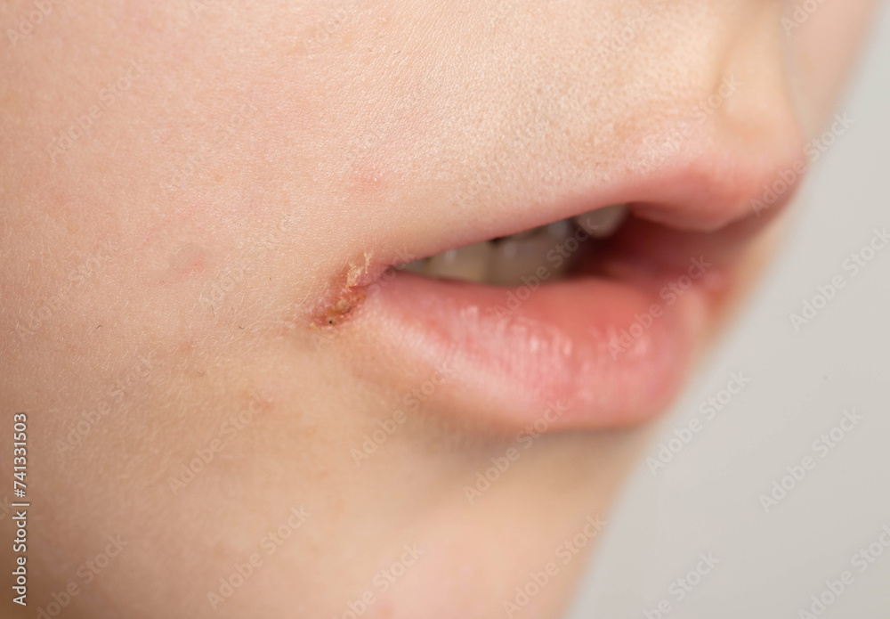 Pain and itching in the corners of the lips of a girl's mouth. Seizures ...
