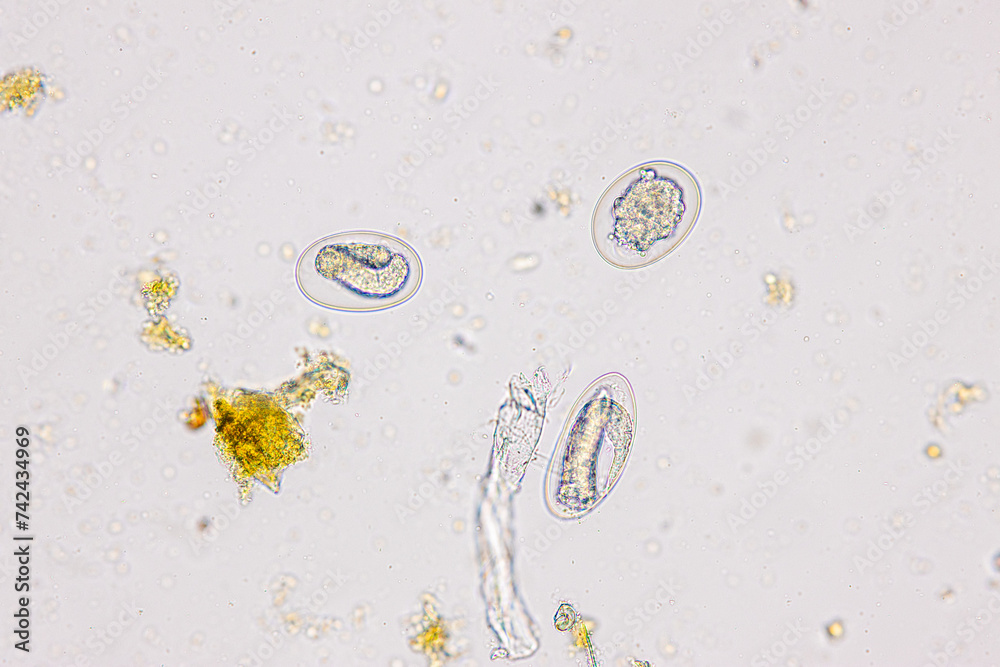Finding Trichuris trichiura egg and Strongyloides egg in the feces ...