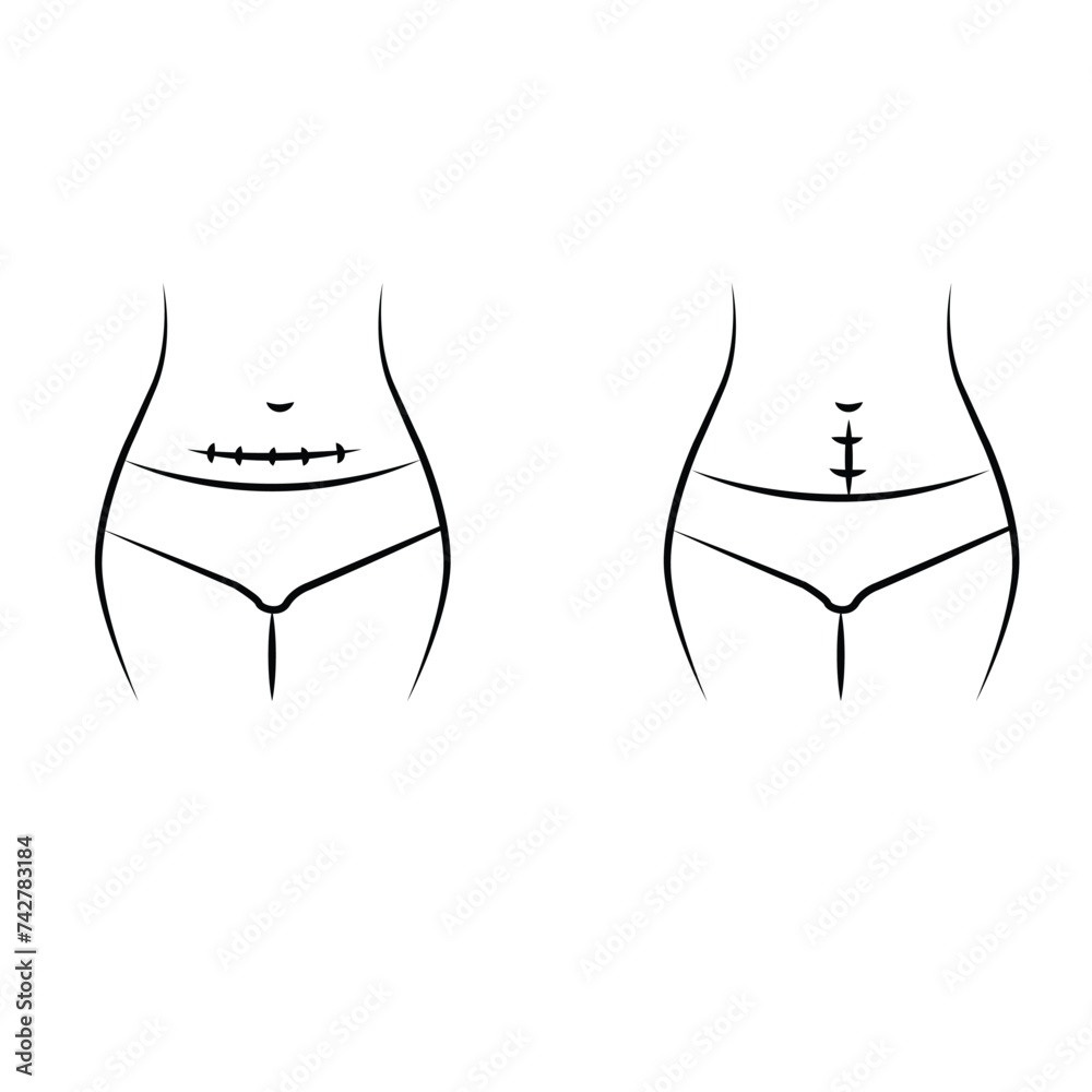 Stomach of a woman with a vertical and horizontal cesarean scar, type of c section vector ...
