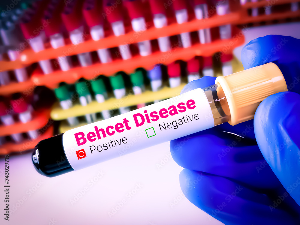 Blood sample for Behcet's disease (BD) test, HLA B51 (human leukocyte ...