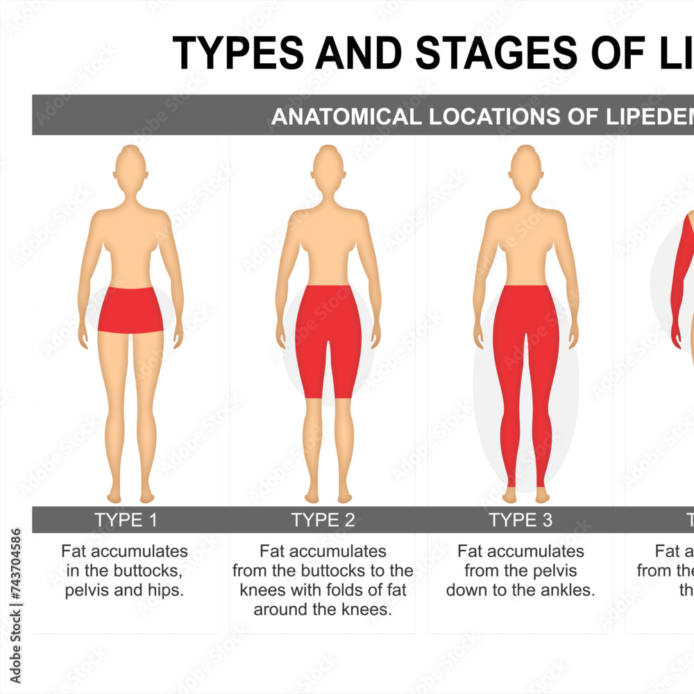 Types of Lipedema Medical Educational Illustration Stock Vector | Adobe ...