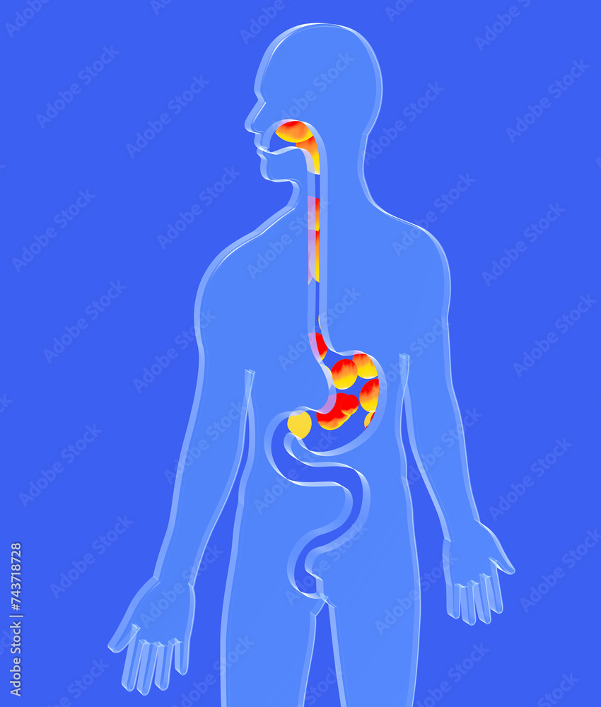 3d illustration of esophagus with gastric reflux and heartburn. With ...
