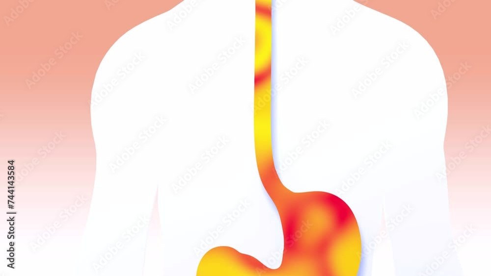 3d animation of stomach and esophagus with fire. Burning and reflux ...