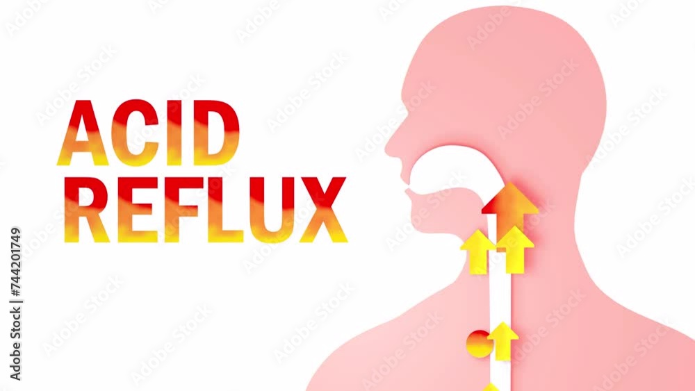 3d animation of esophagus with gastric reflux and heartburn. With ...