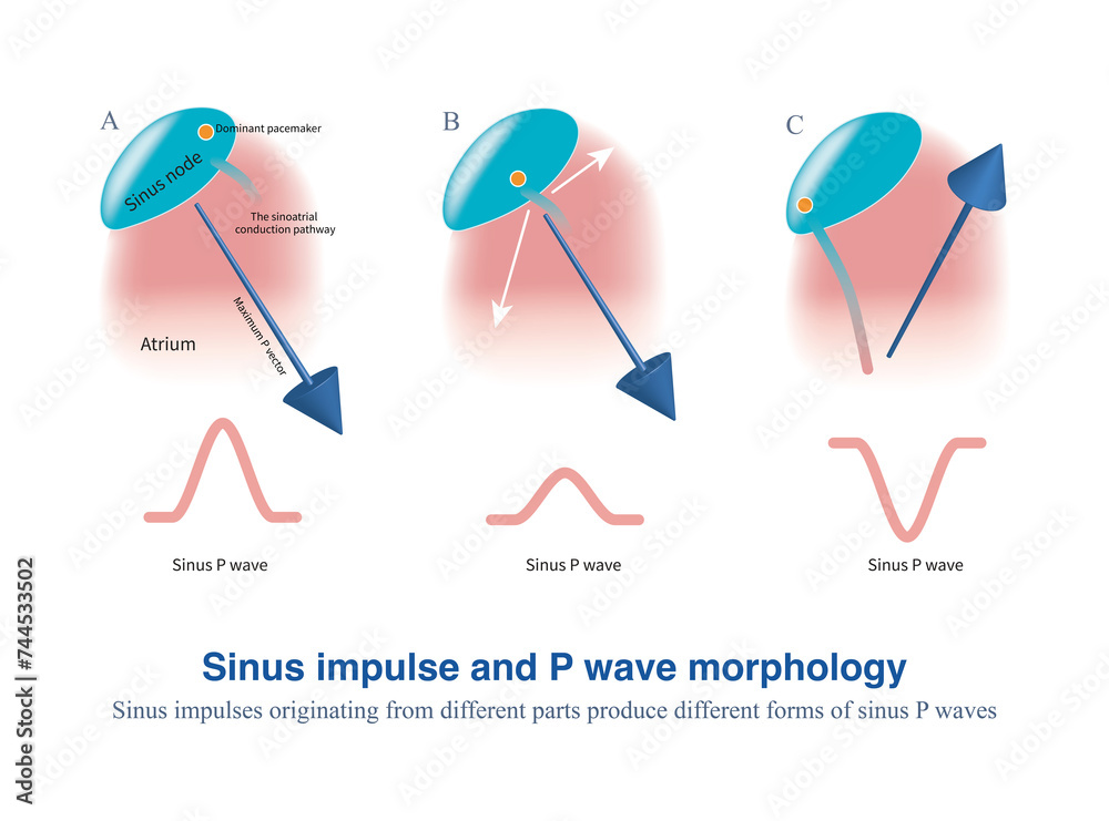 Sinus impulses from different parts of the sinoatrial node produce ...