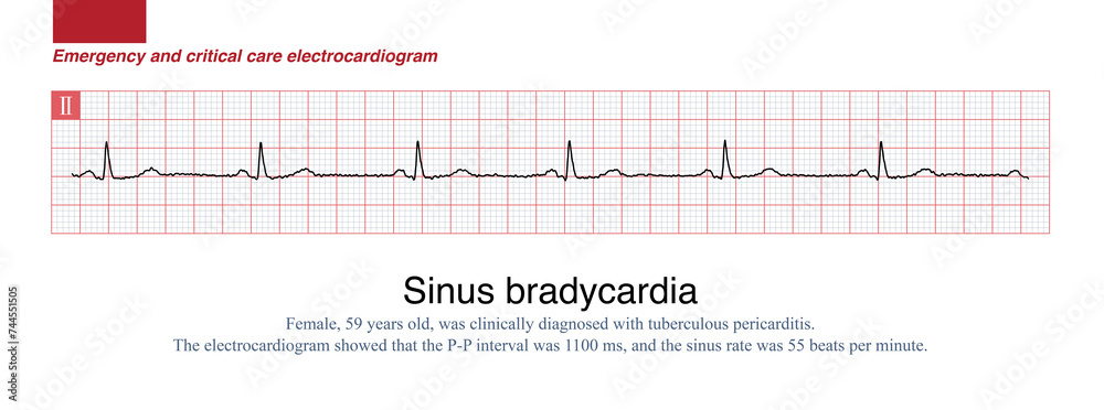 When the frequency of sinus rhythm is less than 60 beats per minute, it ...