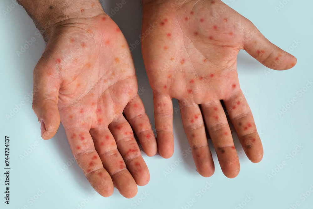 Human Hands with Painful Rash, Red Spots Blisters on the Skin. Health ...