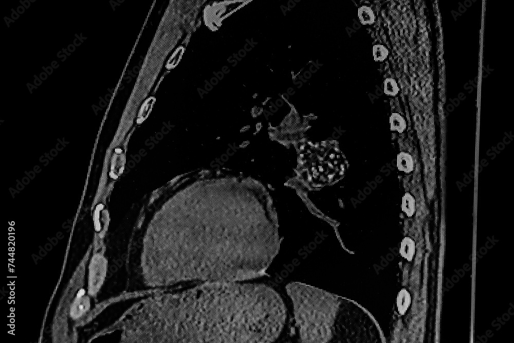 Lateral view of chest CAT- SCAN that shows popcorn calcification a ...