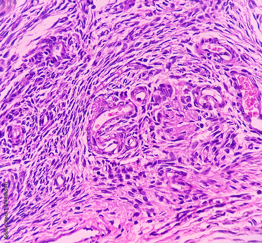 Uterus with adnexa (biopsy): Cervix show chronic inflamatory cells ...
