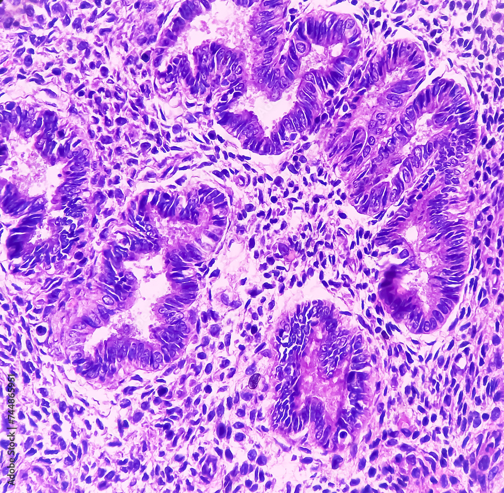 Uterus with adnexa (biopsy): Cervix show chronic inflamatory cells ...