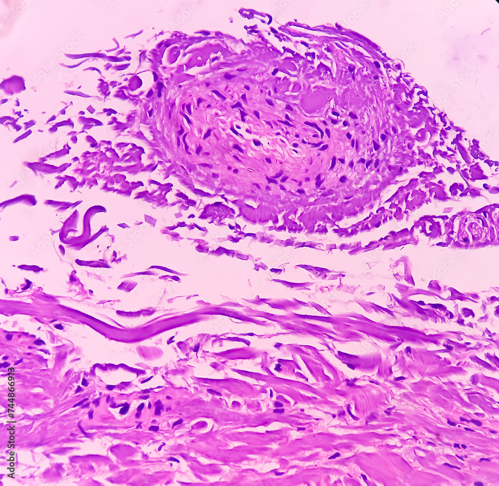Swelling of middle finger (biopsy). Lobular Capillary hemangioma. A ...