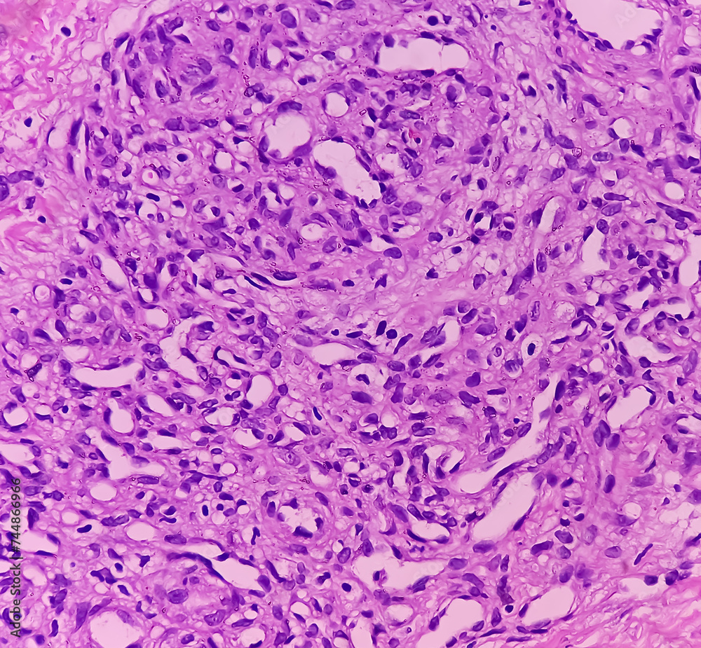 Swelling of middle finger (biopsy). Lobular Capillary hemangioma. A ...