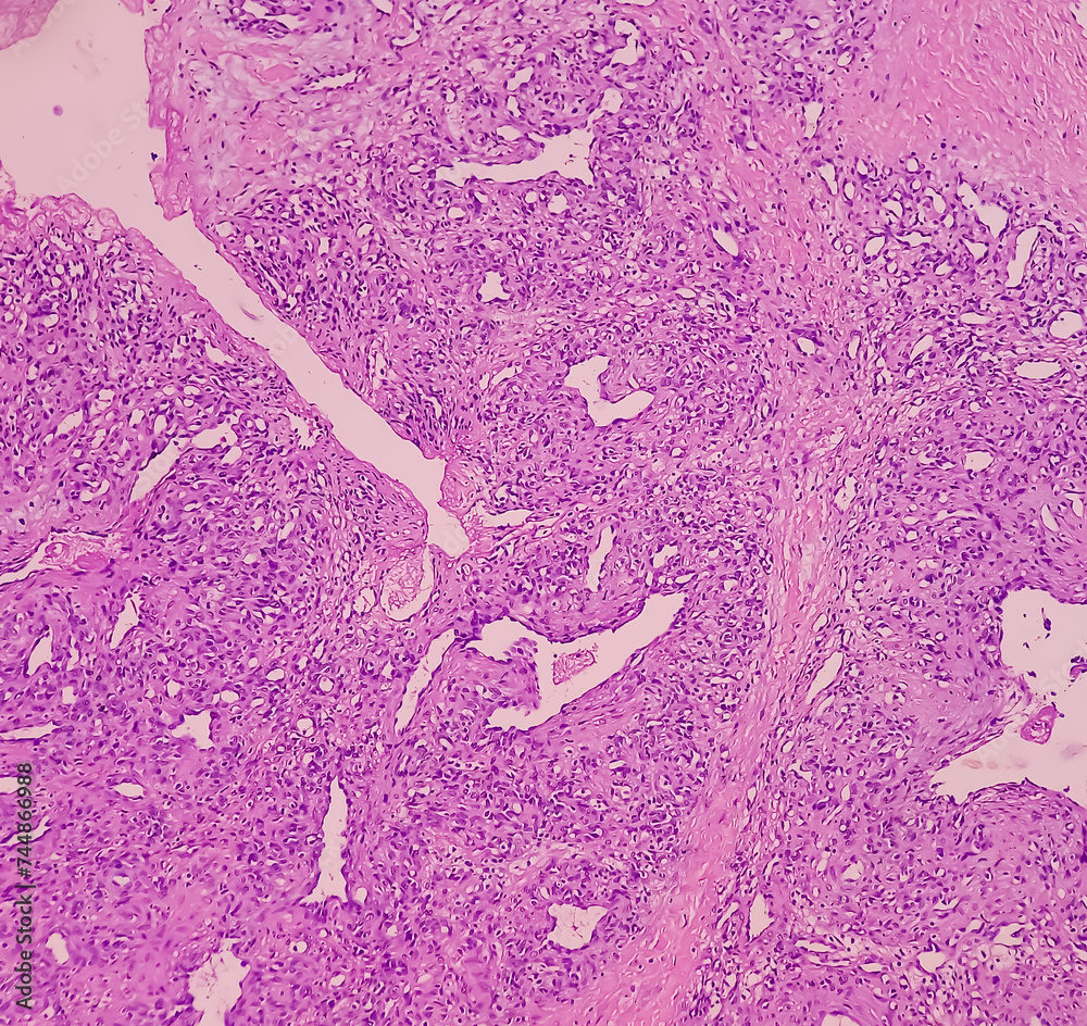 Swelling of middle finger (biopsy). Lobular Capillary hemangioma. A ...