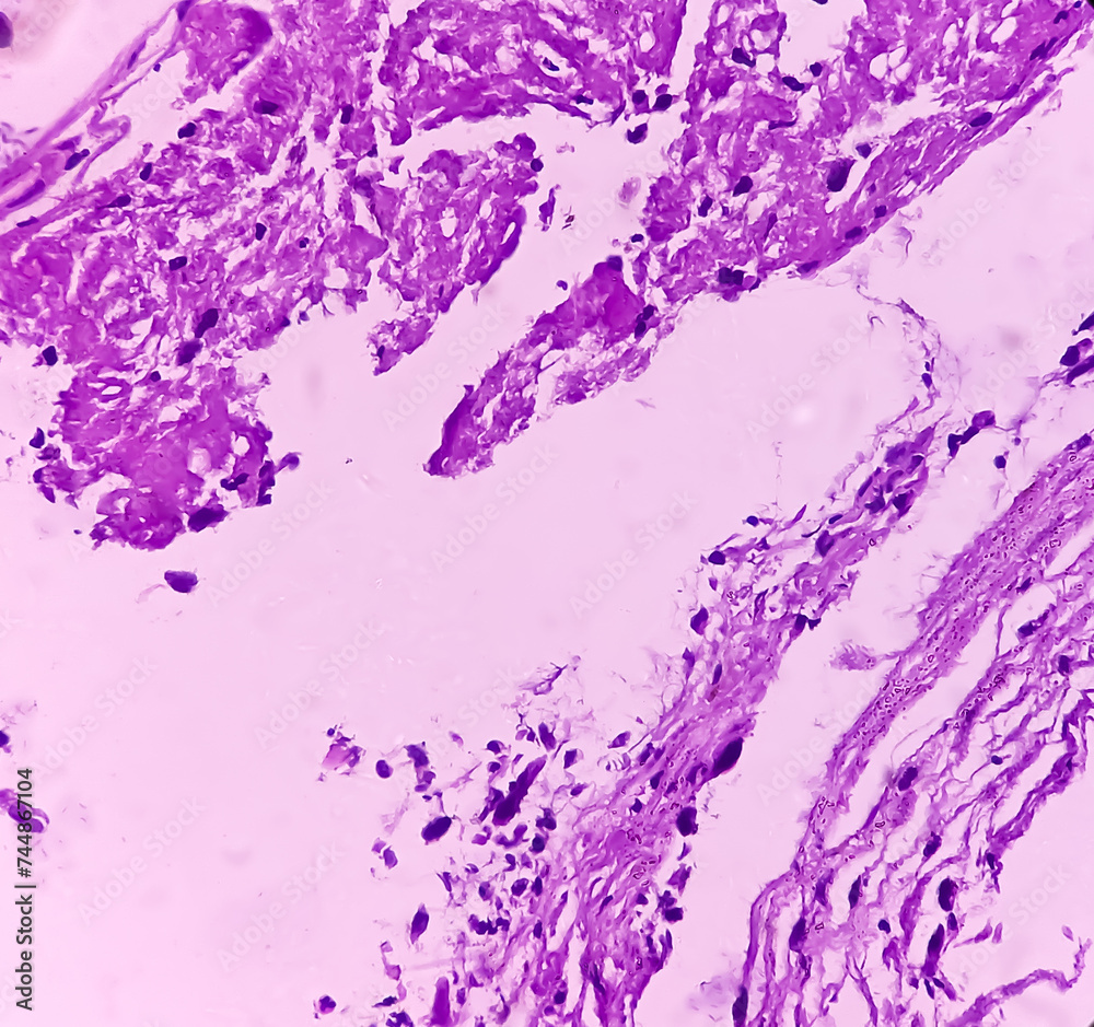 Pleural tissue (biopsy): Section show fibro collagenous tissue. focal ...