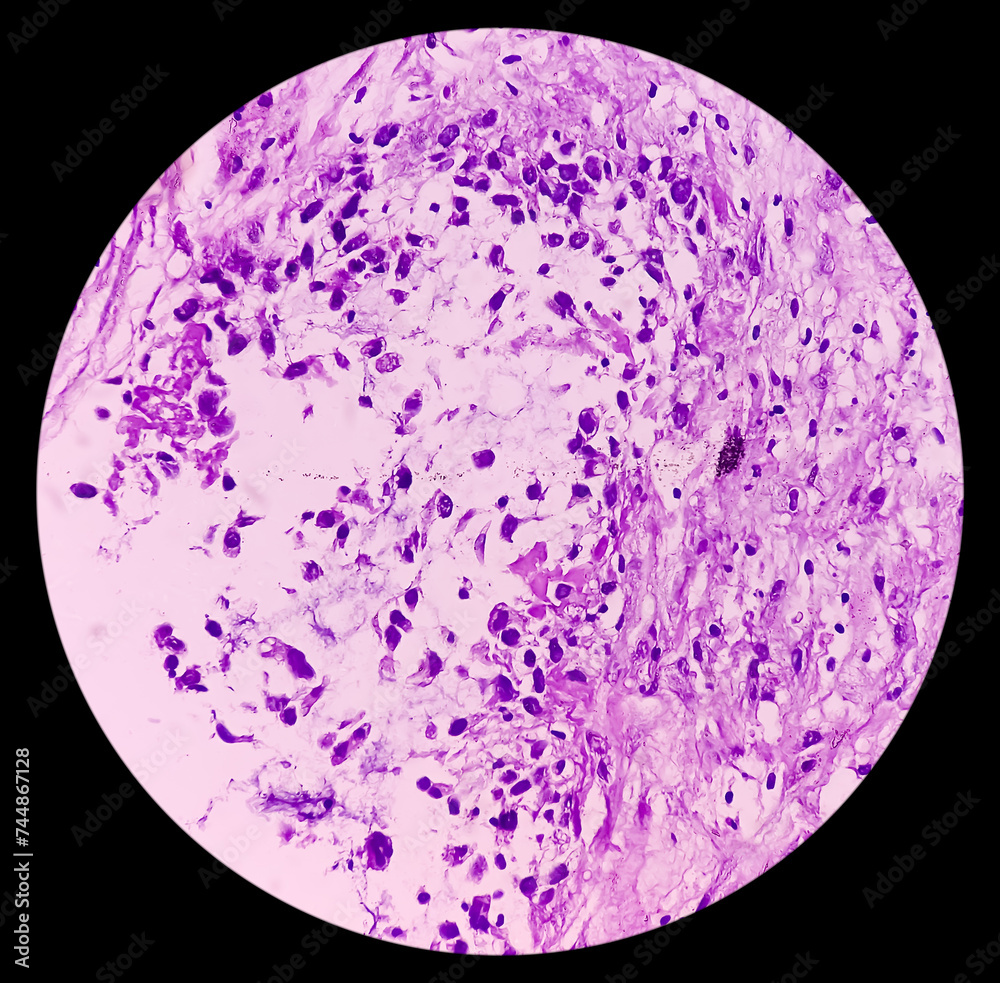 Pleural tissue (biopsy): Section show fibro collagenous tissue. focal ...