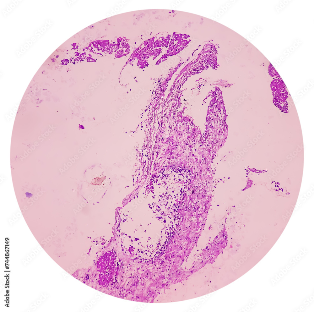Pleural tissue (biopsy): Section show fibro collagenous tissue. focal ...