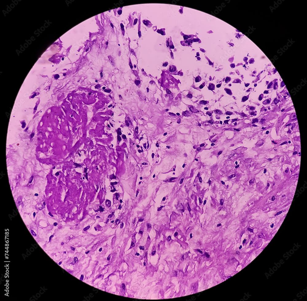 Pleural tissue (biopsy): Section show fibro collagenous tissue. focal ...