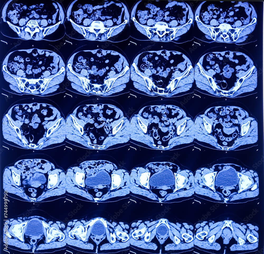 CT scan of KUB (non-contrast): Left renal tiny calculi (without ...