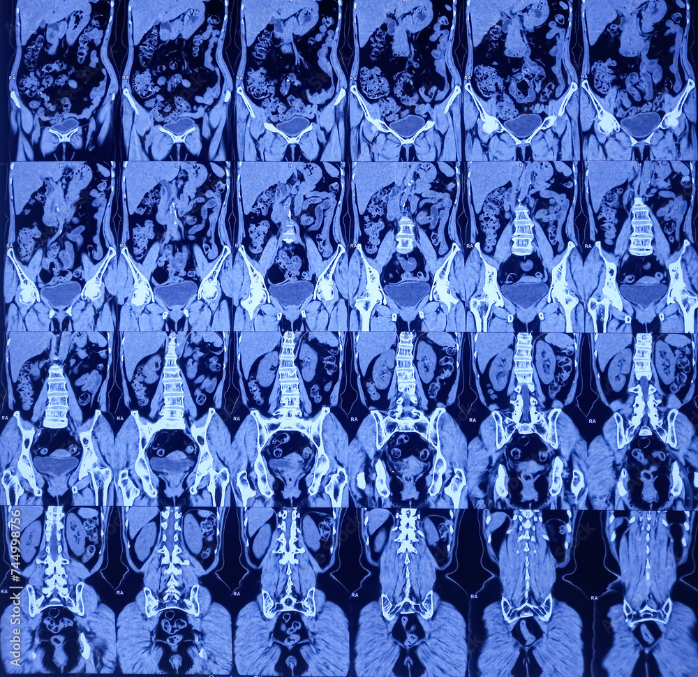 CT scan of KUB (non-contrast): Left renal tiny calculi (without ...
