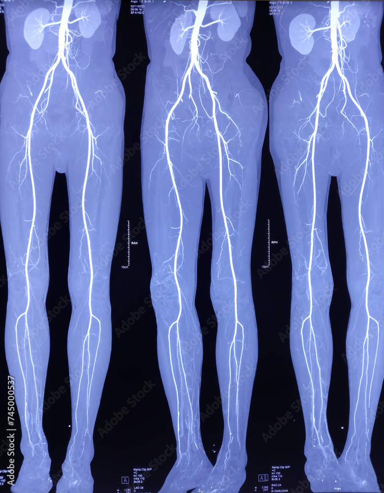 CT angiogram (CTA) shown the abdominal aorta, kidney and common iliac ...