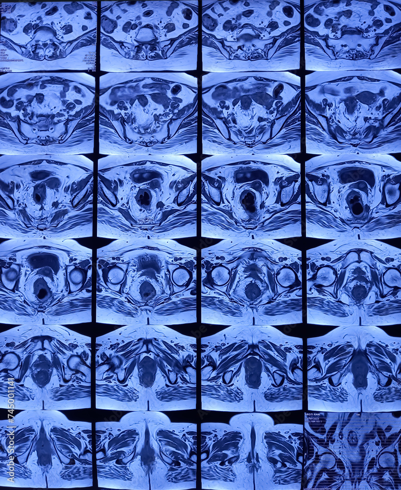 MRI (Magnetic Resonance Imaging) scan of pelvis (female). Ca rectum ...