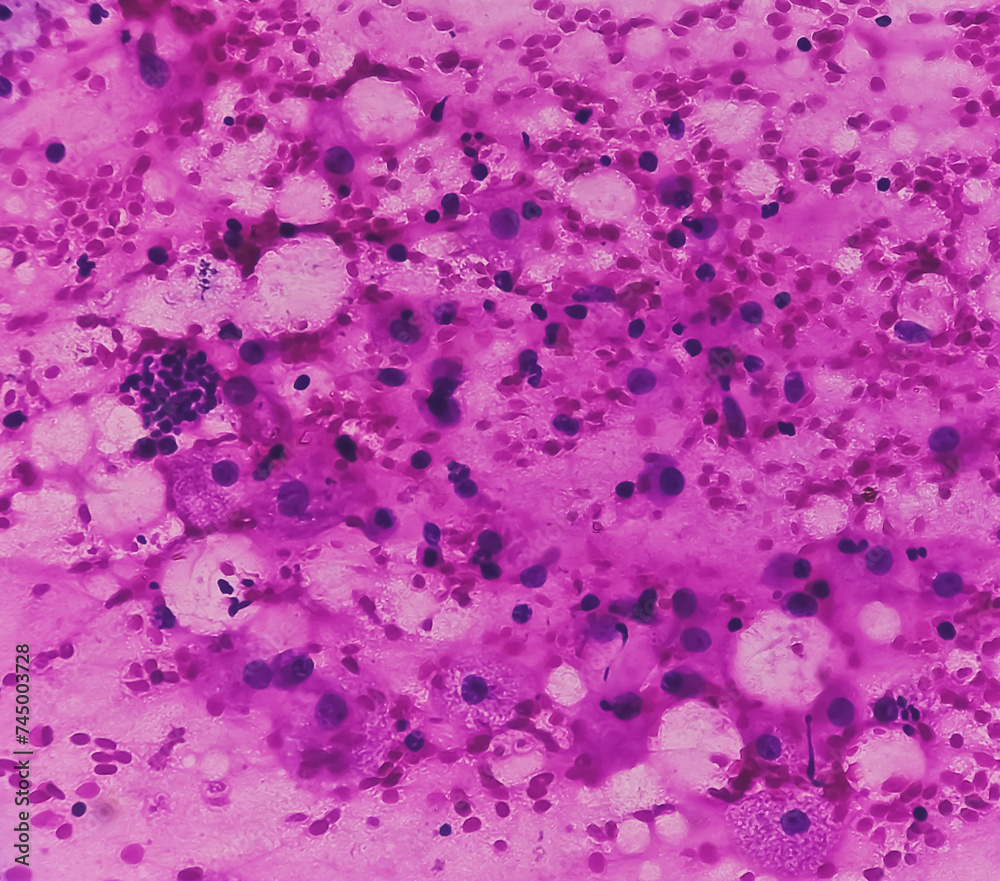 FNA cytology of swelling of chest wall. Infected epidermal inclusion ...