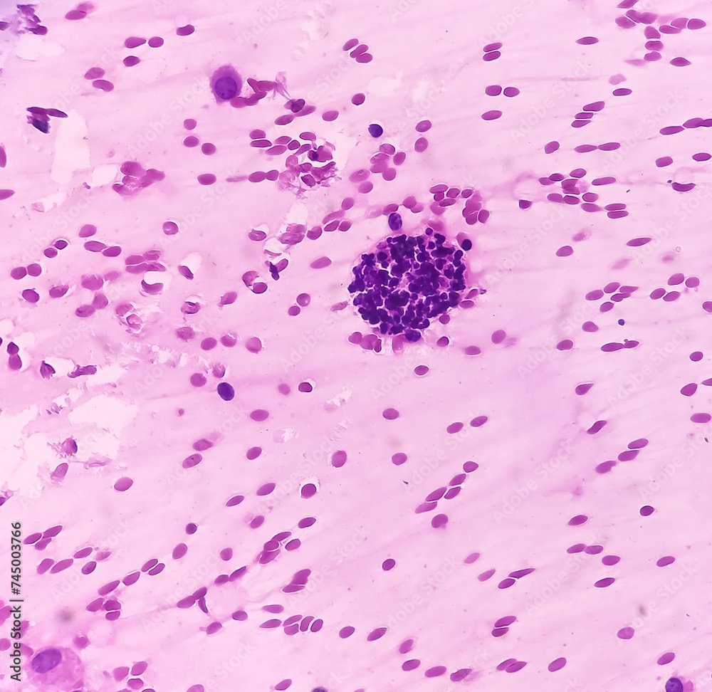 FNA cytology of swelling of chest wall. Infected epidermal inclusion ...