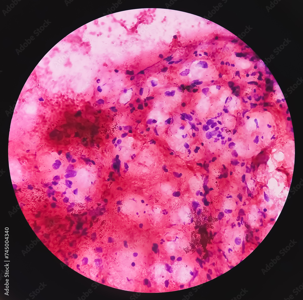 CT Guaided FNA cytology from left hilar mass. Microscopic show atypical ...