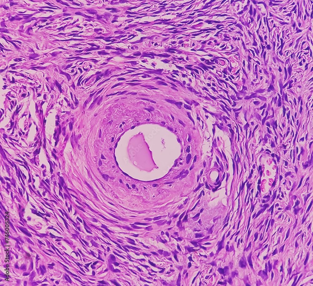 Photo of benign brenner tumor of ovary, showing tumor sheet on the ...