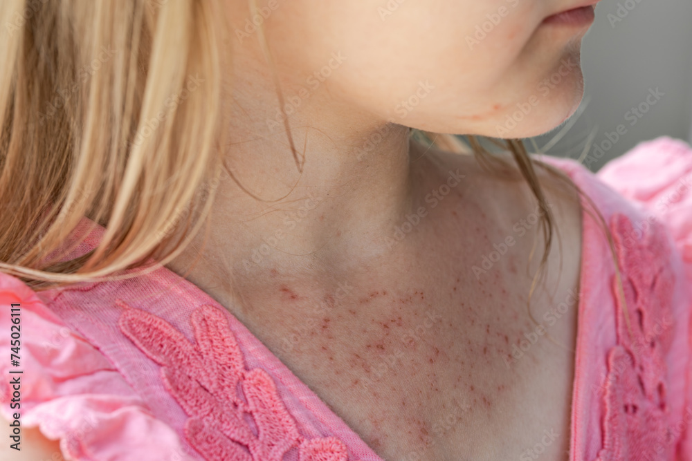 coxsackievirus, Singapore flu, skin rashes, blisters, viral infection ...