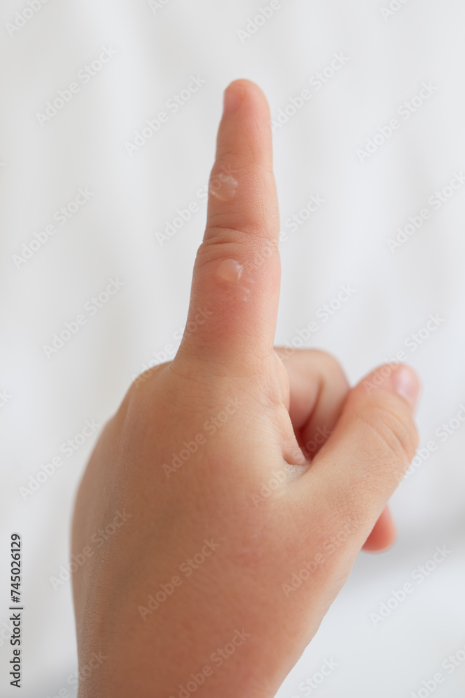 coxsackievirus, Singapore flu, skin rashes, blisters, viral infection ...