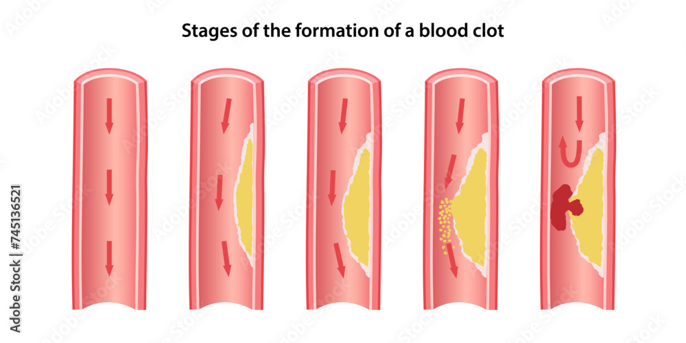 Stages of the formation of blood clot. Vector illustration in flat ...